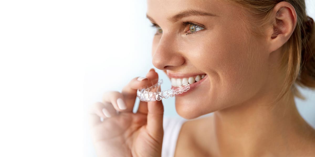 Aligners orthodontique | MM Dental – Laboratoire Dentaire