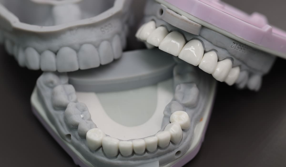 Restaurations PMMA pour les gros cas sur mandibulaire et maxilaire | MM ...